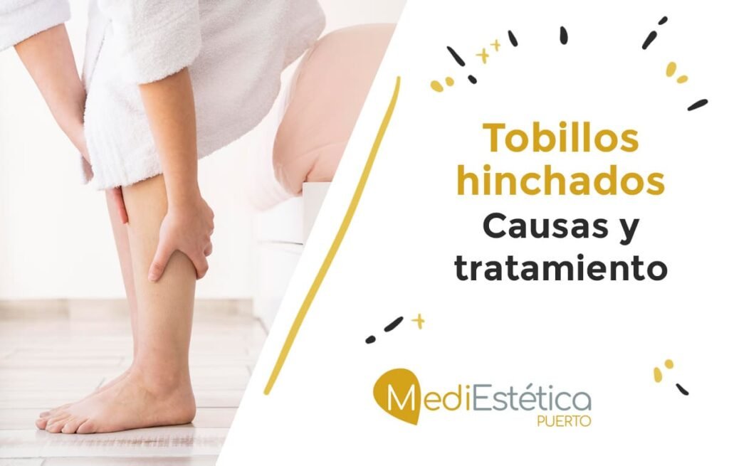 ️ Tobillos Hinchados [Causas y Tratamiento 2026]
